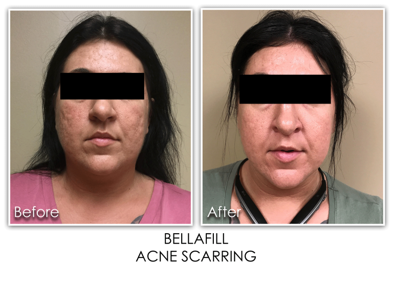 Bellafill - Skin Rejuvenation Clinic Skin Rejuvenation Clinic