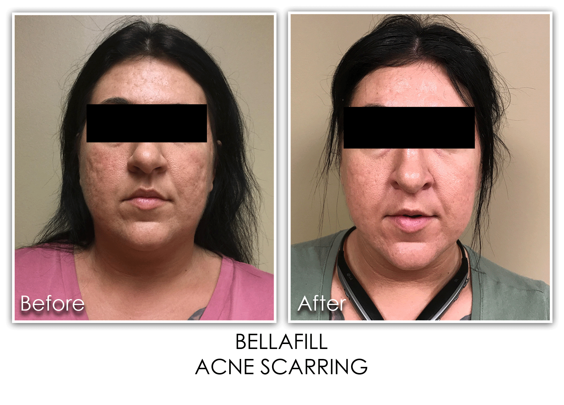 3 DERMAL FILLER ACNE SCARRING - Skin Rejuvenation Clinic Skin ...