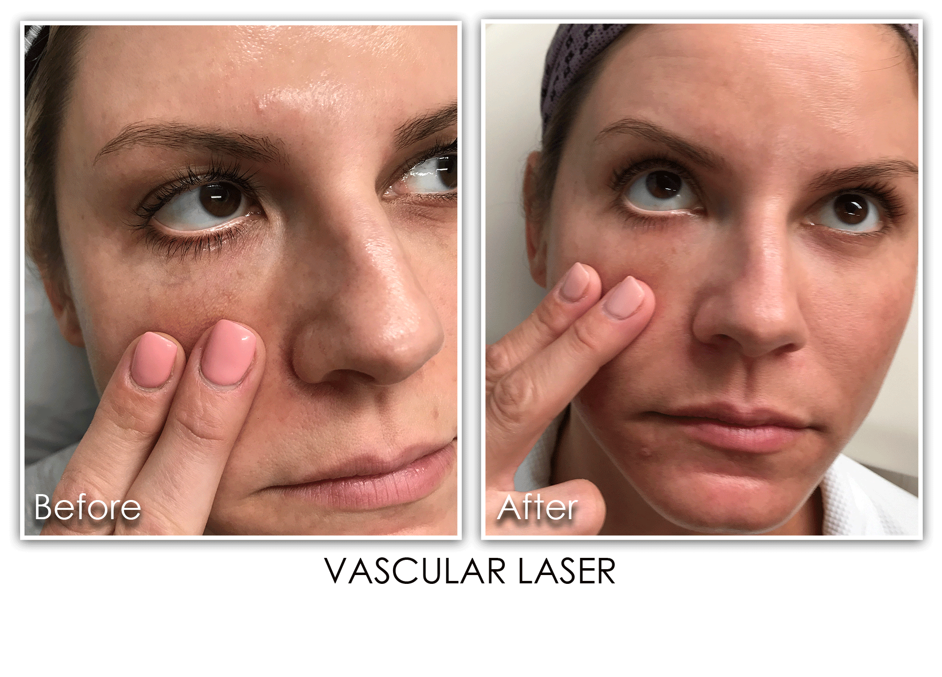 3 Vascualr Skin Rejuvenation Clinic Skin Rejuvenation Clinic