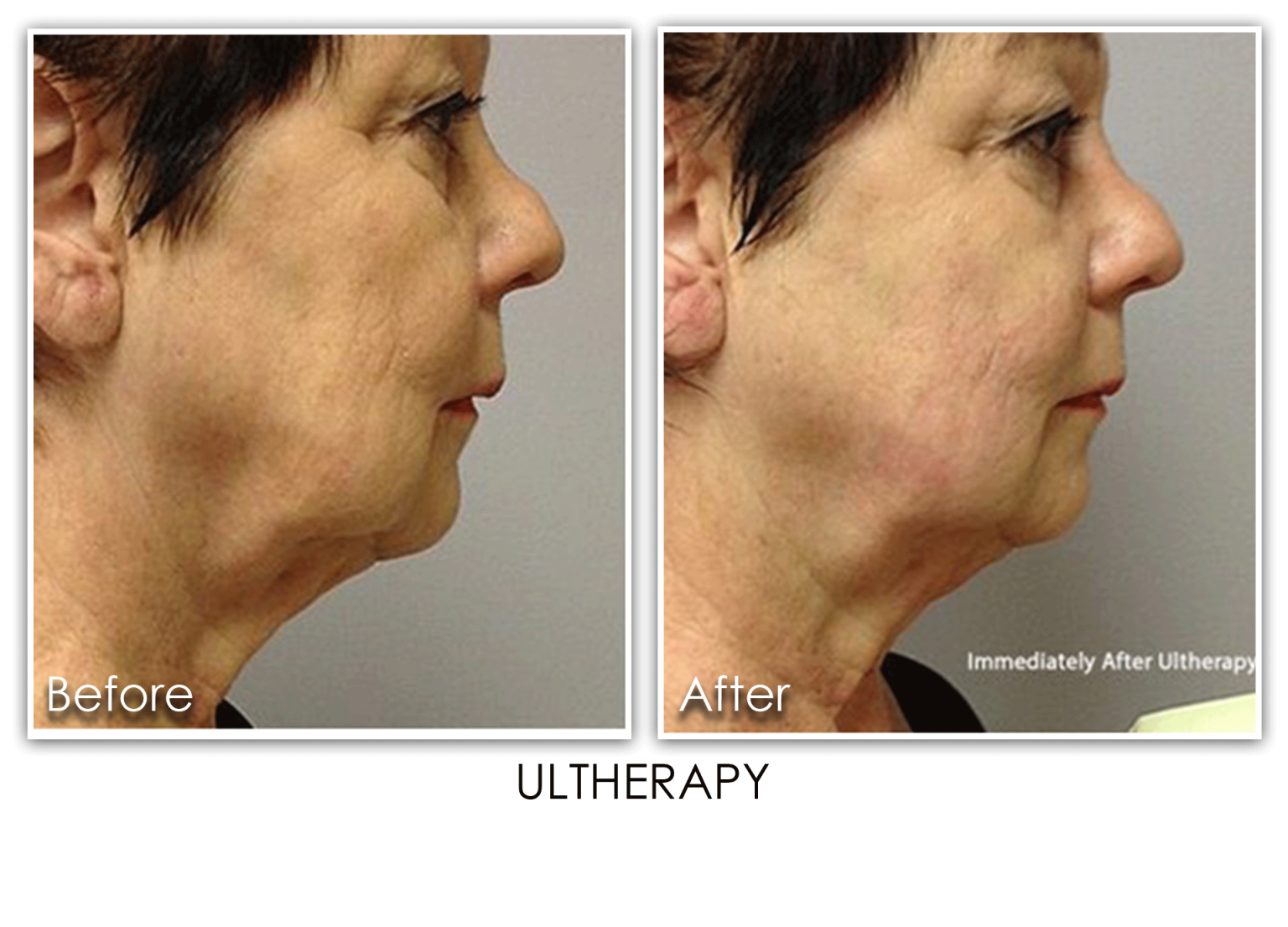 Ultherapy (Non-Surgical Facelift) | Skin Rejuvenation Clinic Skin ...