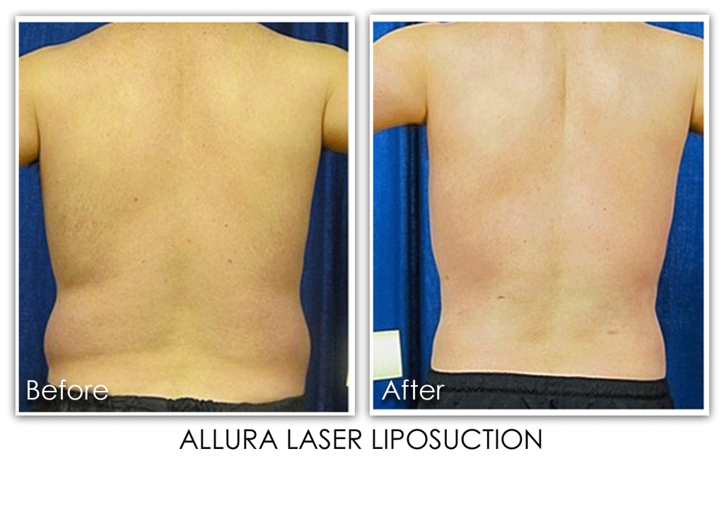 Body Contouring For Men | Skin Rejuvenation Clinic Skin Rejuvenation Clinic