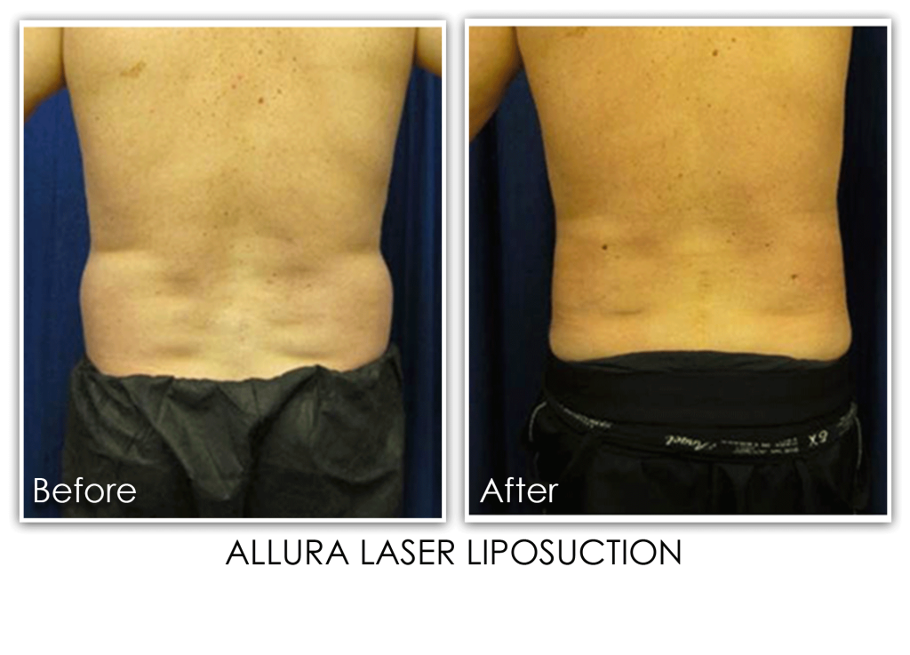 Body Contouring for Men Archives - Skin Rejuvenation Clinic Skin ...
