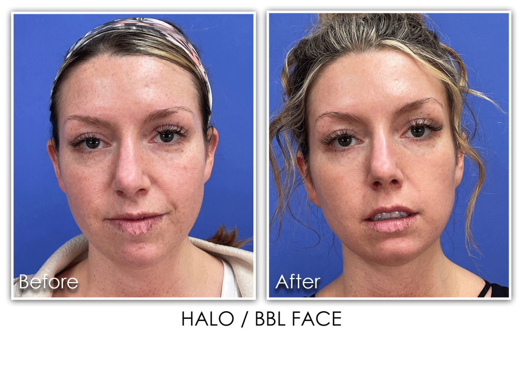 BBL Forever Young | Skin Rejuvenation Clinic Skin Rejuvenation Clinic