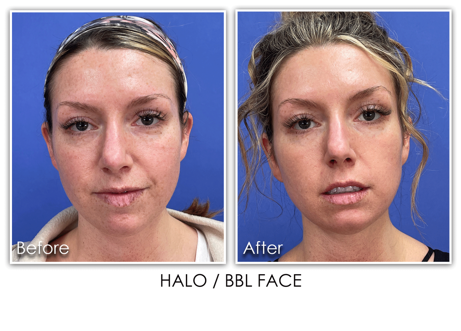 BBL Forever Young | Skin Rejuvenation Clinic Skin Rejuvenation Clinic