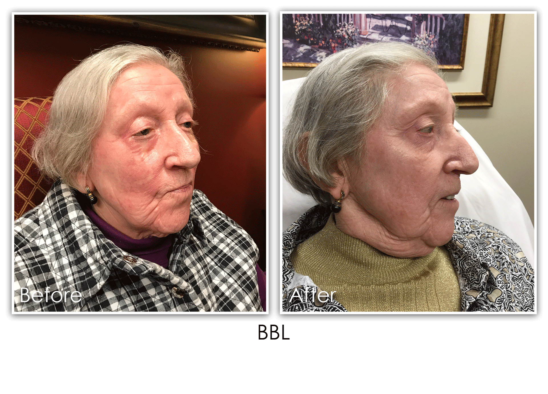 2 BBL - Skin Rejuvenation Clinic Skin Rejuvenation Clinic