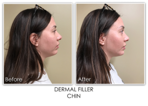4 DERMAL FILLER CHIN - Skin Rejuvenation Clinic Skin Rejuvenation Clinic