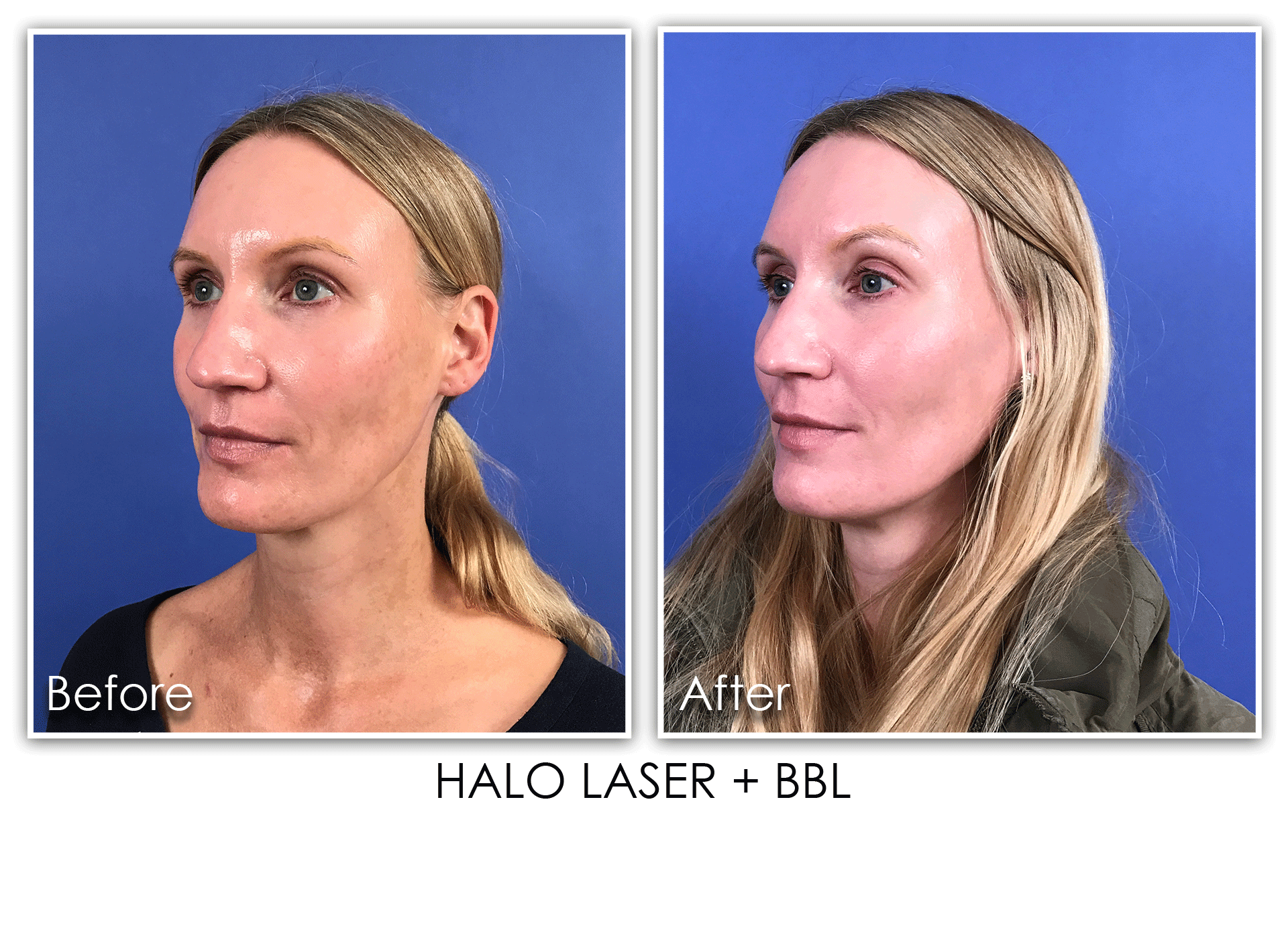 4 HALO / BBL - Skin Rejuvenation Clinic Skin Rejuvenation Clinic