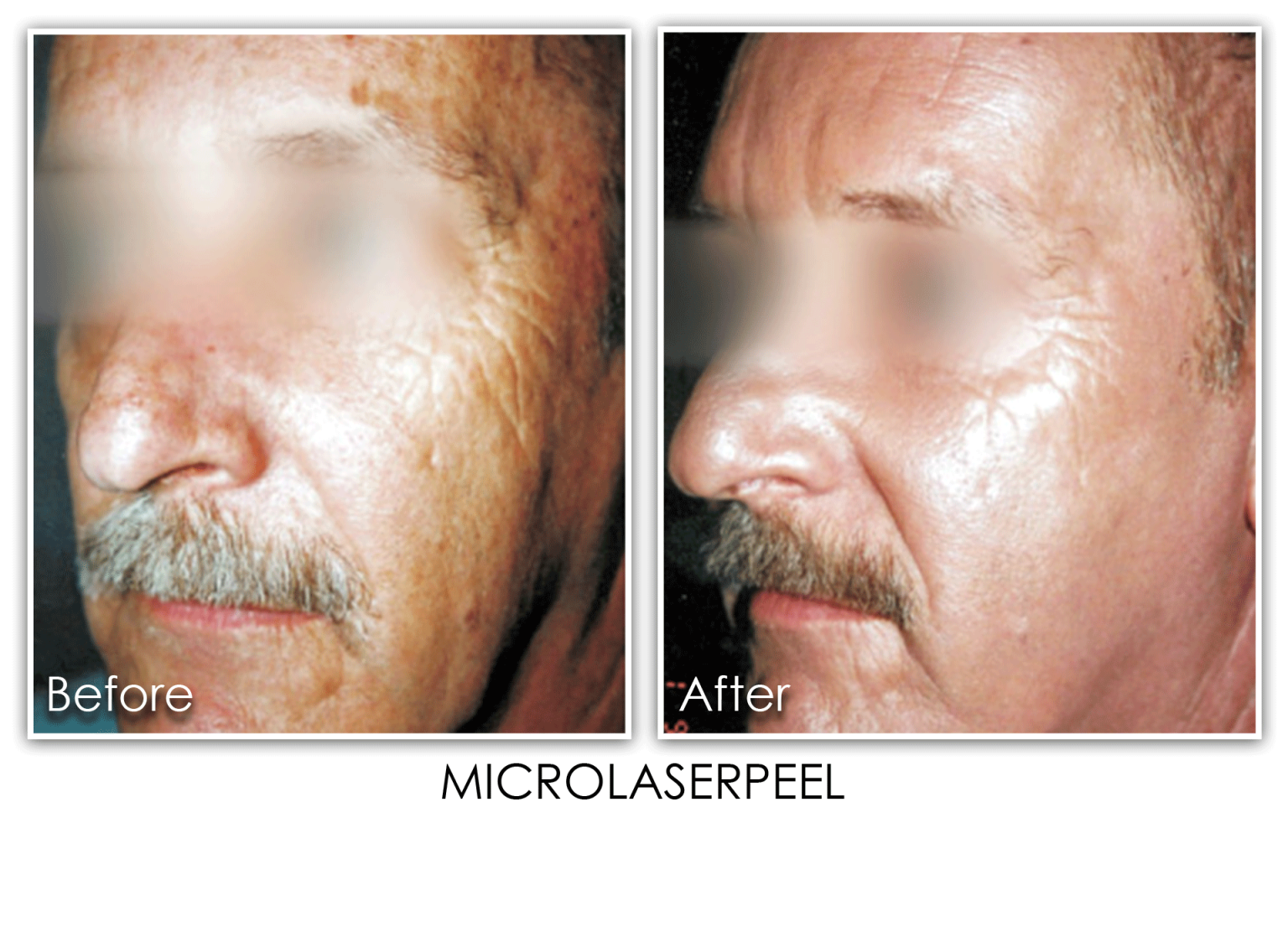 MicroLaserPeel - Skin Rejuvenation Clinic Skin Rejuvenation Clinic