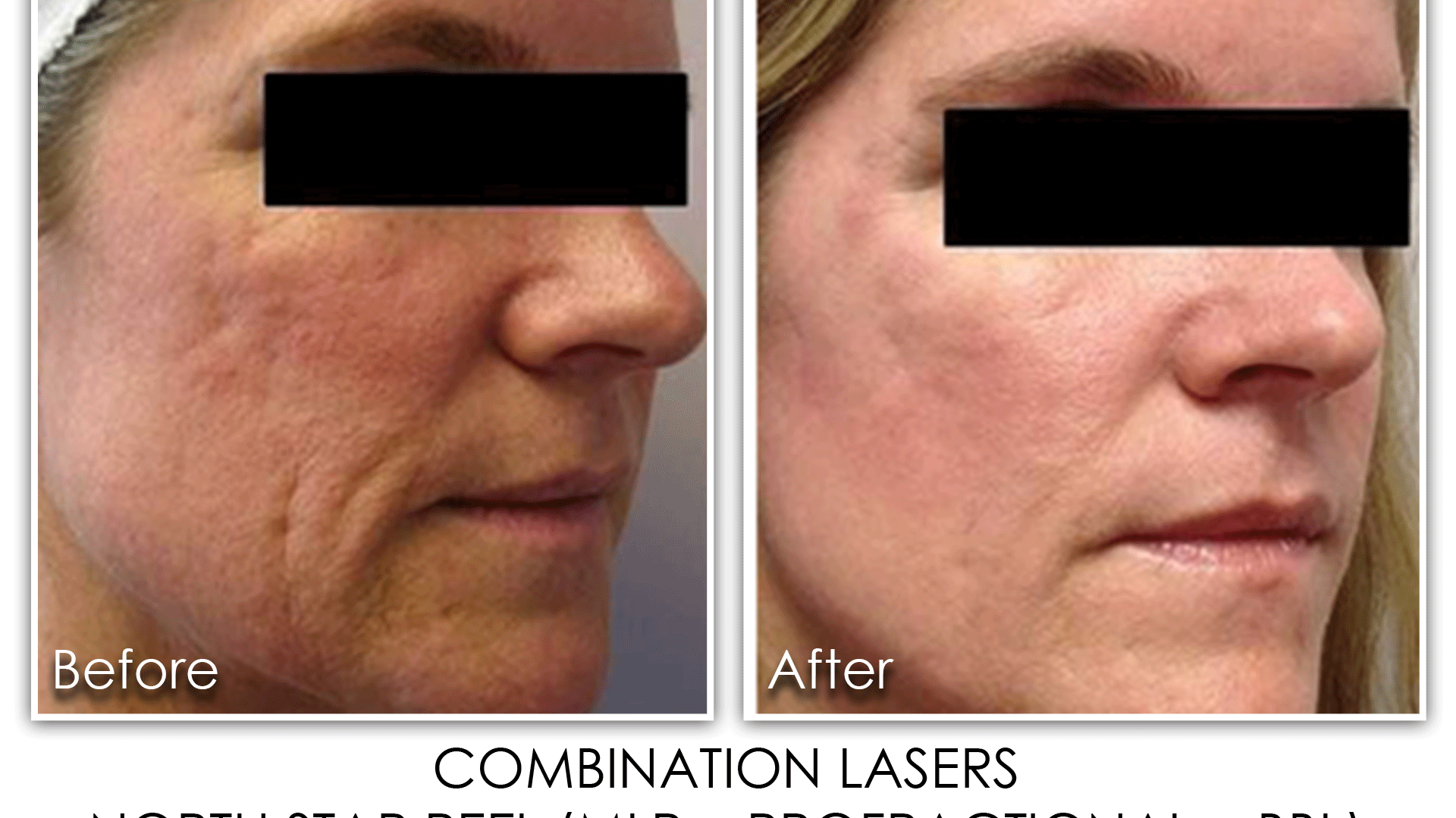 4 Combination Laser Skin Rejuvenation Clinic Skin Rejuvenation Clinic