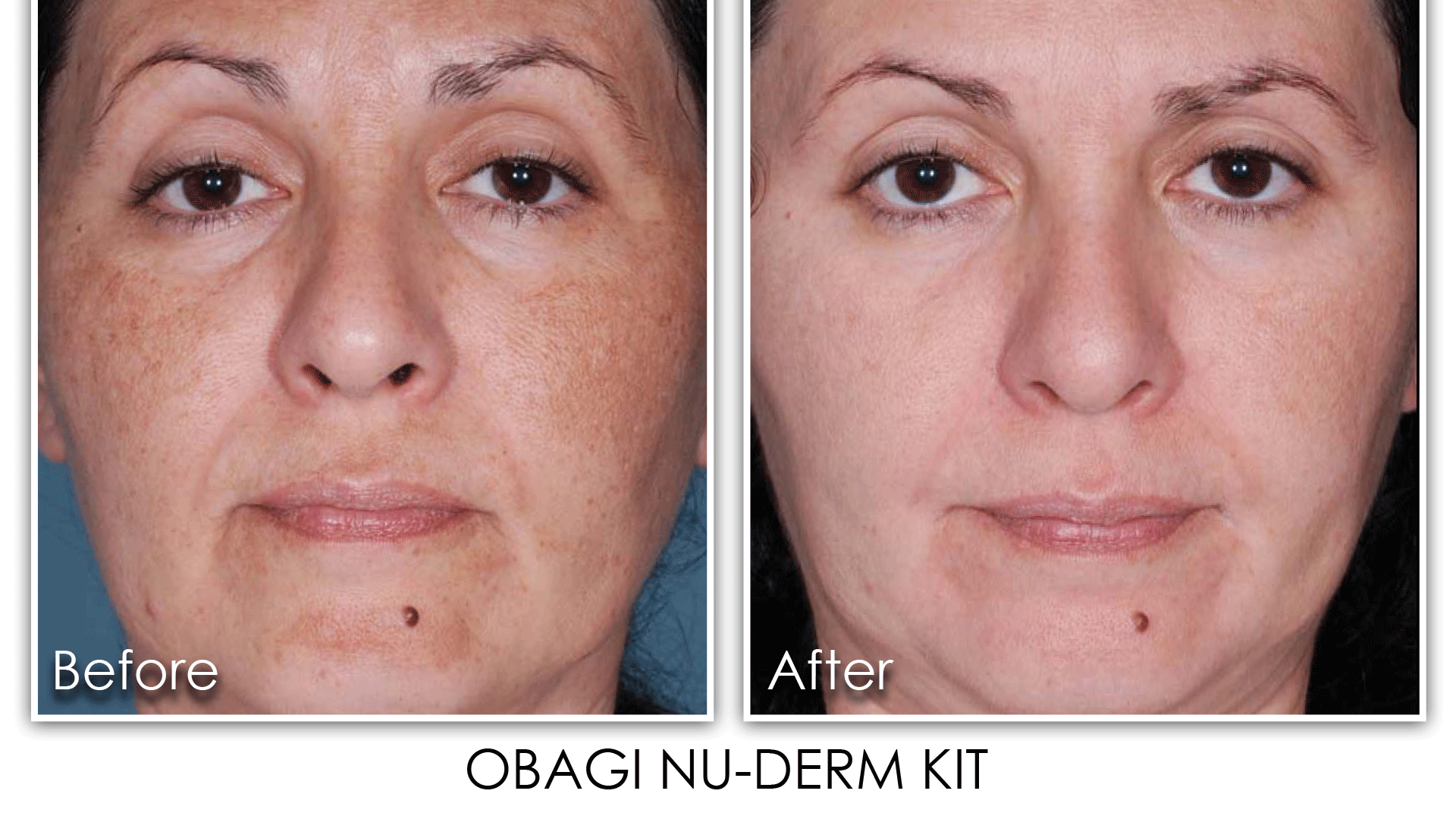 4 Obagi Nu Derm Kit - Skin Rejuvenation Clinic Skin Rejuvenation Clinic