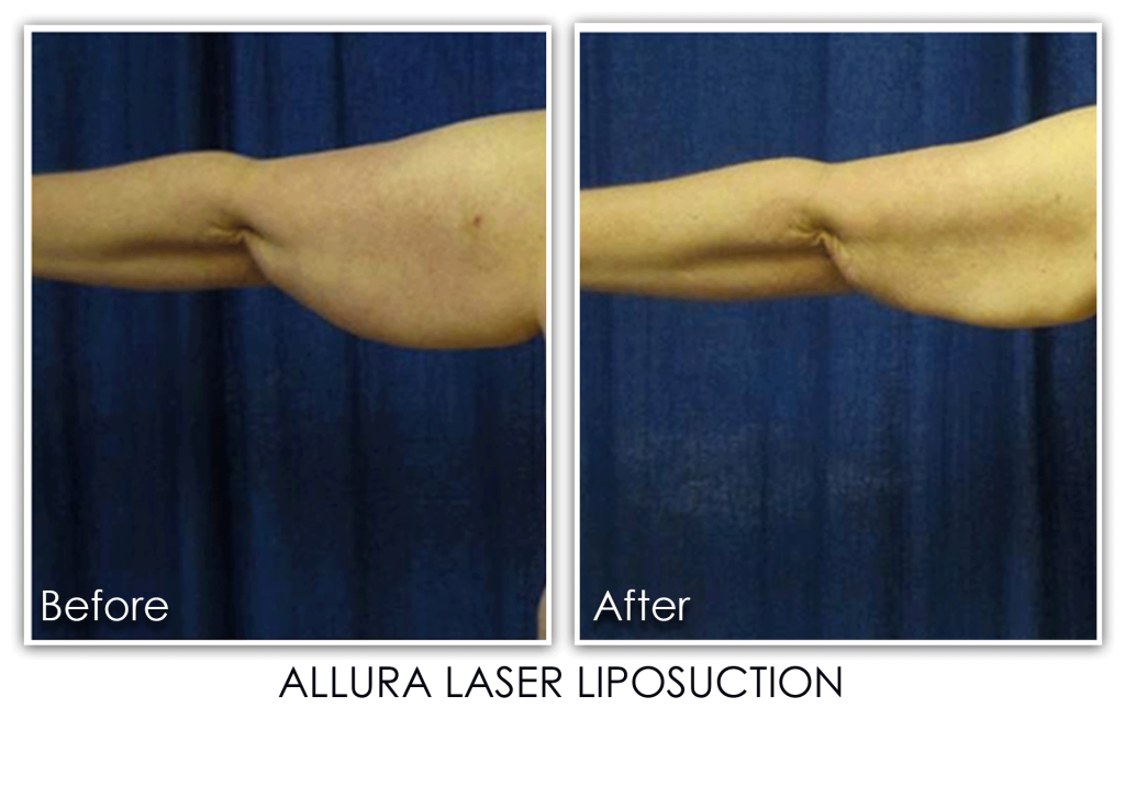 Allura Prolipo Laser Liposuction Archives - Page 2 of 5 | Skin ...