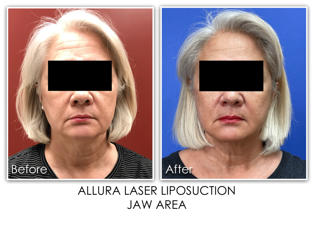 Allura Prolipo Laser Liposuction Archives - Skin Rejuvenation Clinic ...