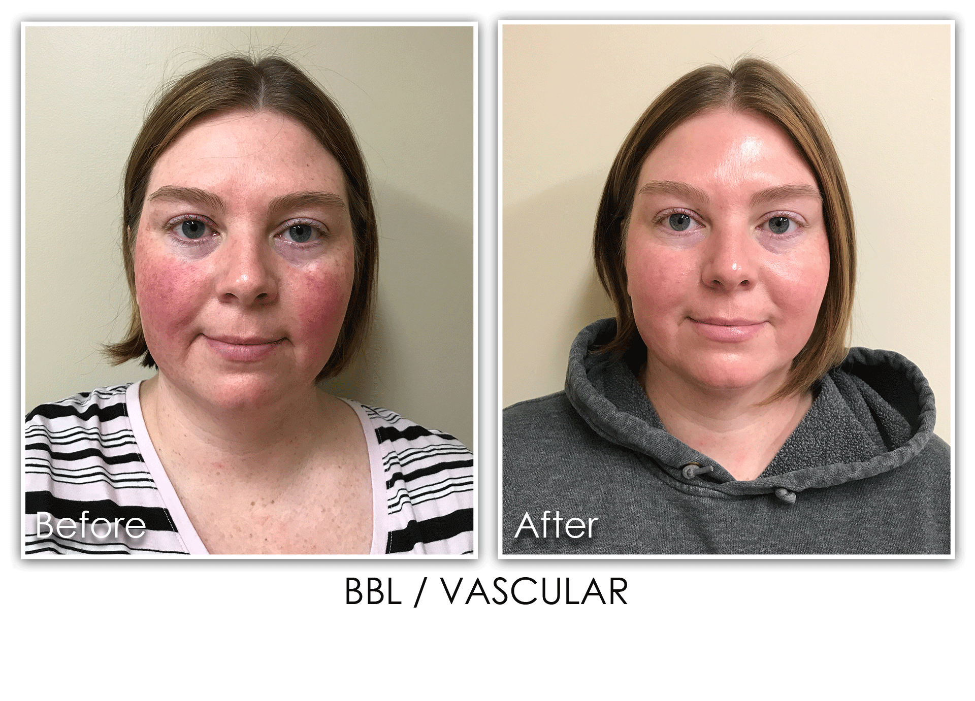 3 BBL - Skin Rejuvenation Clinic Skin Rejuvenation Clinic