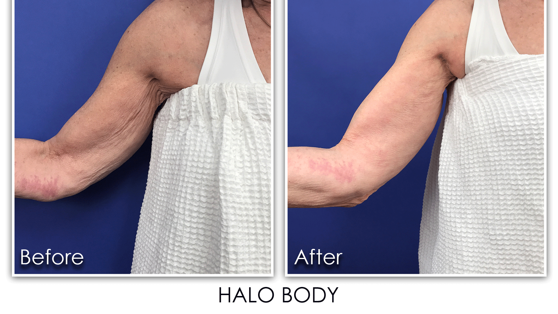 5 HALO BODY - Skin Rejuvenation Clinic Skin Rejuvenation Clinic