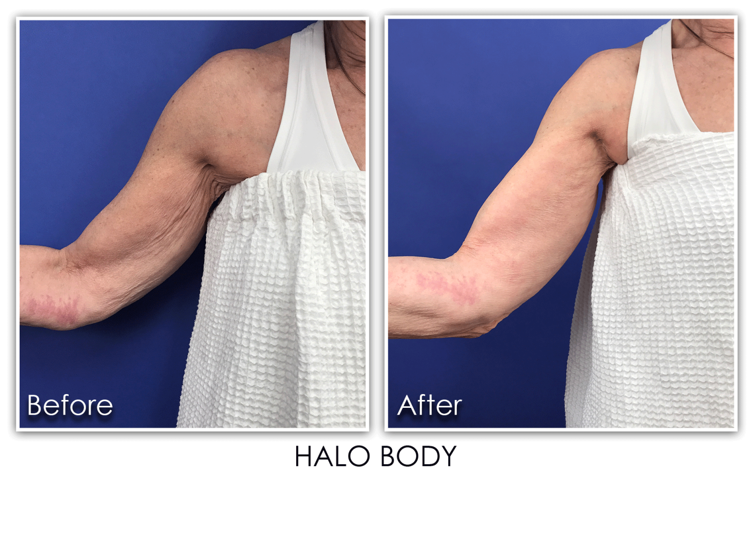 Halo Body | Skin Rejuvenation Clinic Skin Rejuvenation Clinic