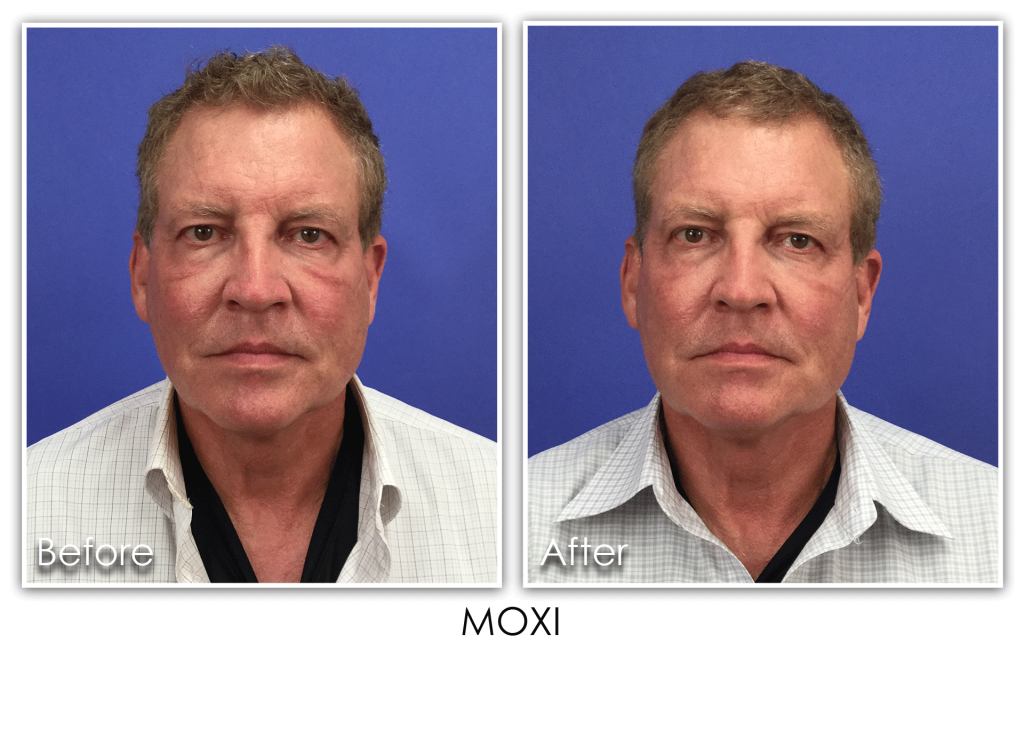 Moxi (Mini Halo) Laser | Skin Rejuvenation Clinic Skin Rejuvenation Clinic