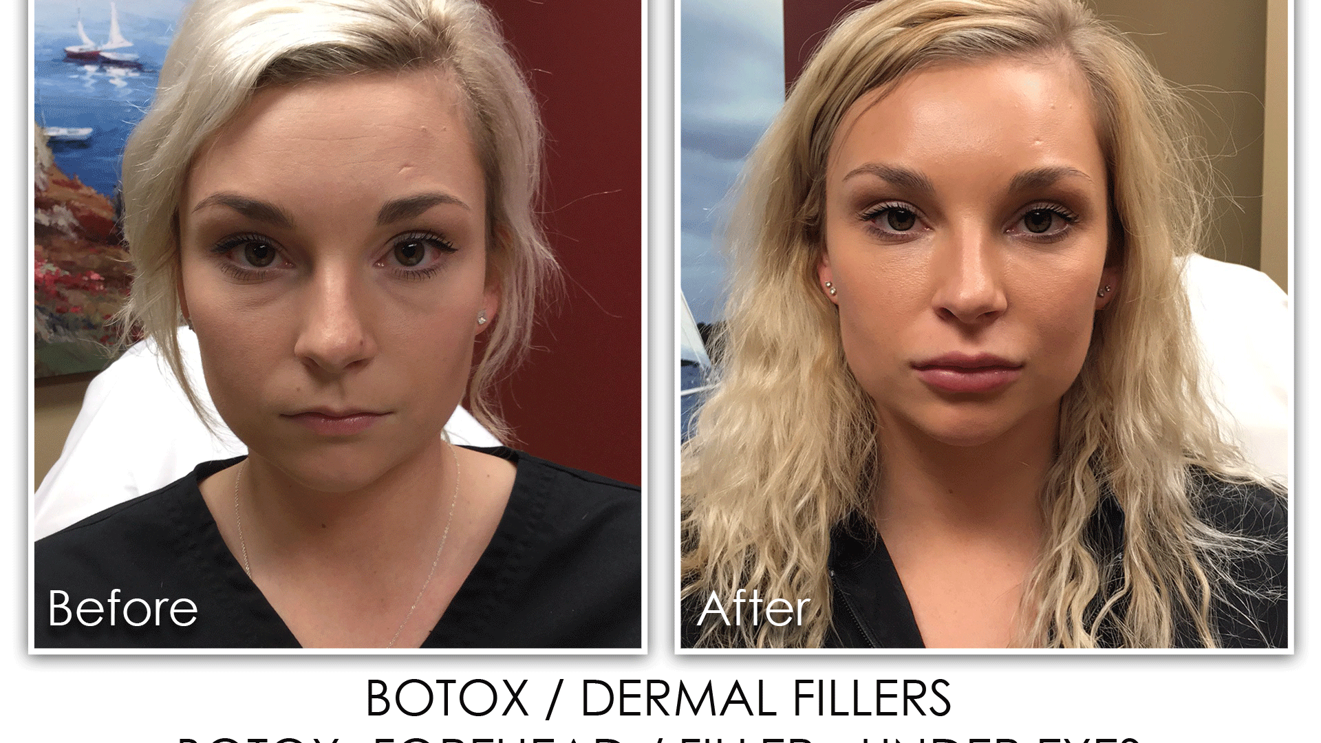 5 Botox - Skin Rejuvenation Clinic Skin Rejuvenation Clinic