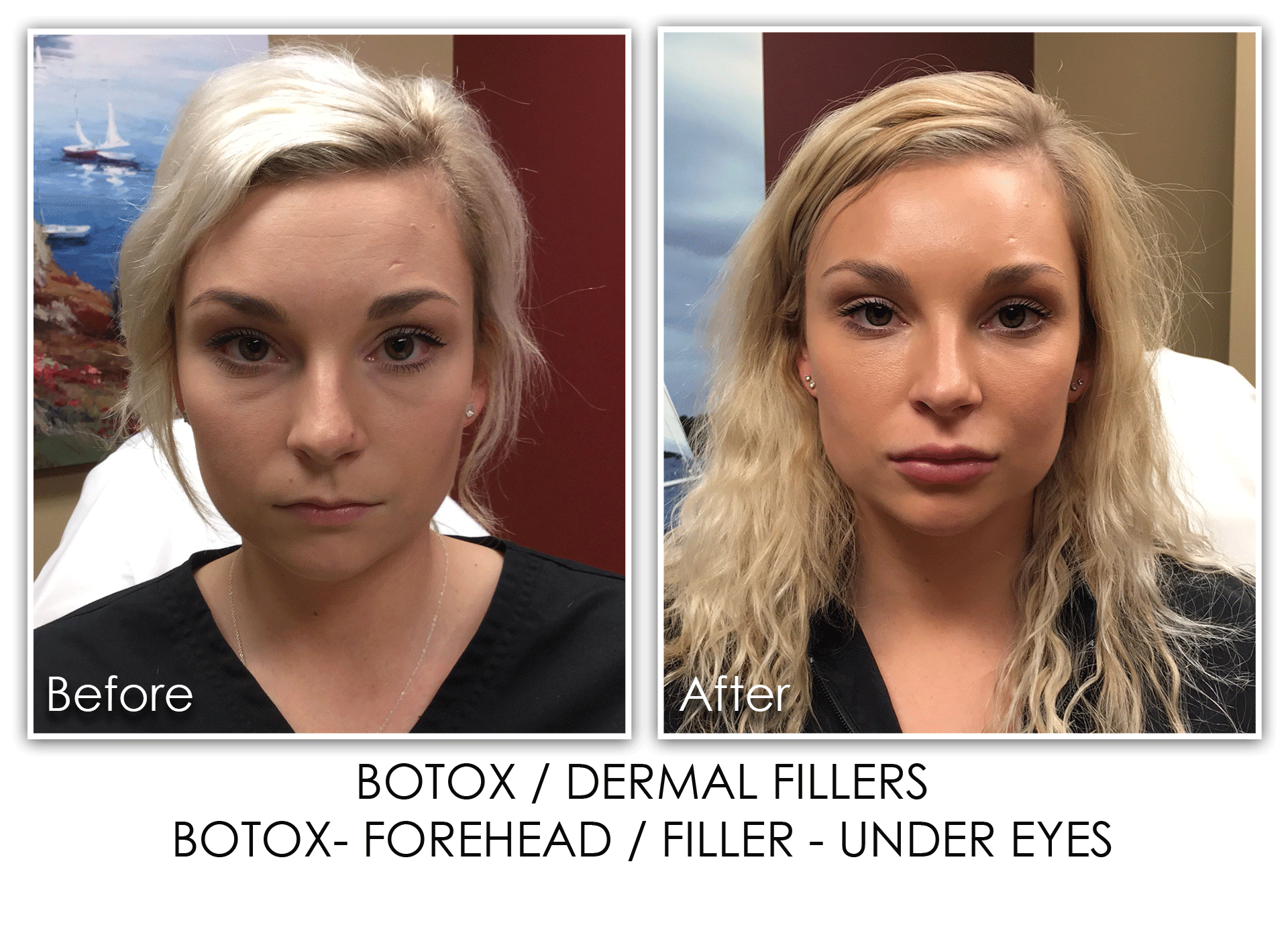 5 Botox - Skin Rejuvenation Clinic Skin Rejuvenation Clinic