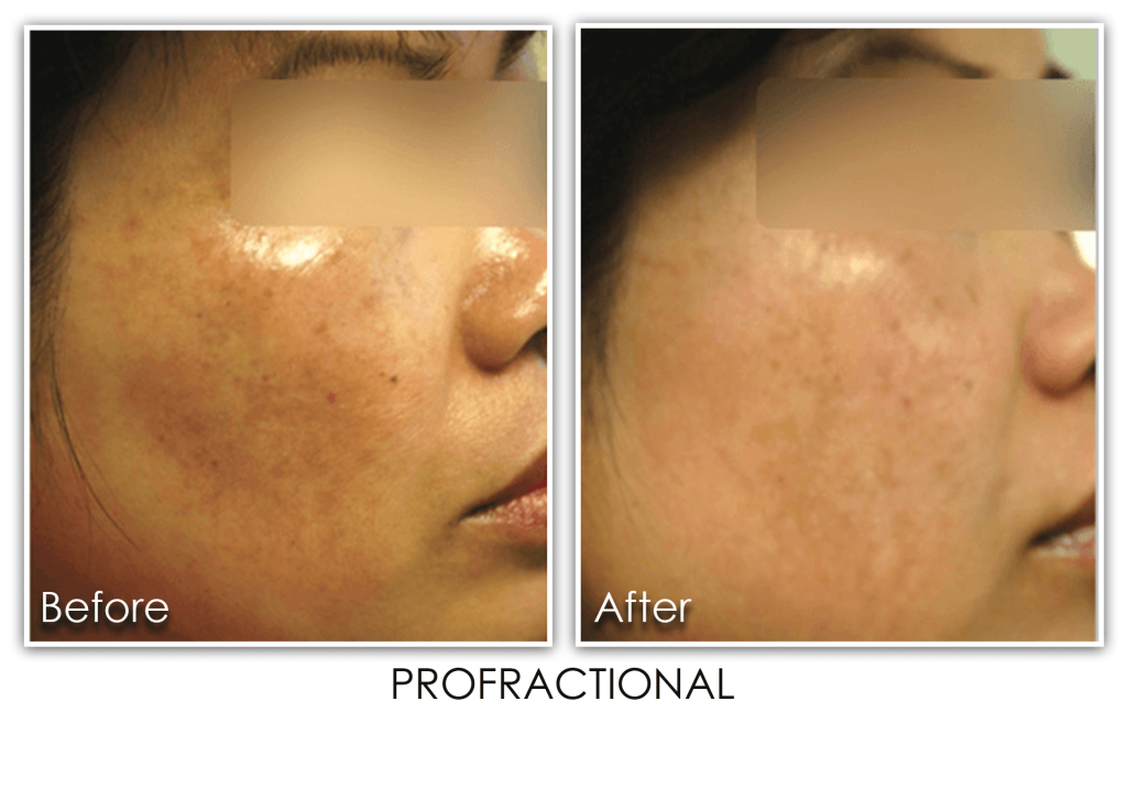 Profractional Laser Resurfacing Archives - Skin Rejuvenation Clinic Skin Rejuvenation Clinic