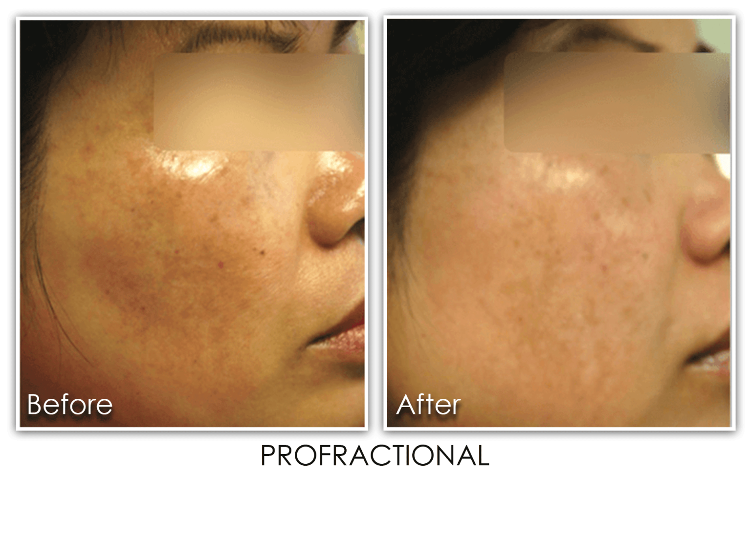 Profractional Laser Resurfacing Archives - Skin Rejuvenation Clinic ...