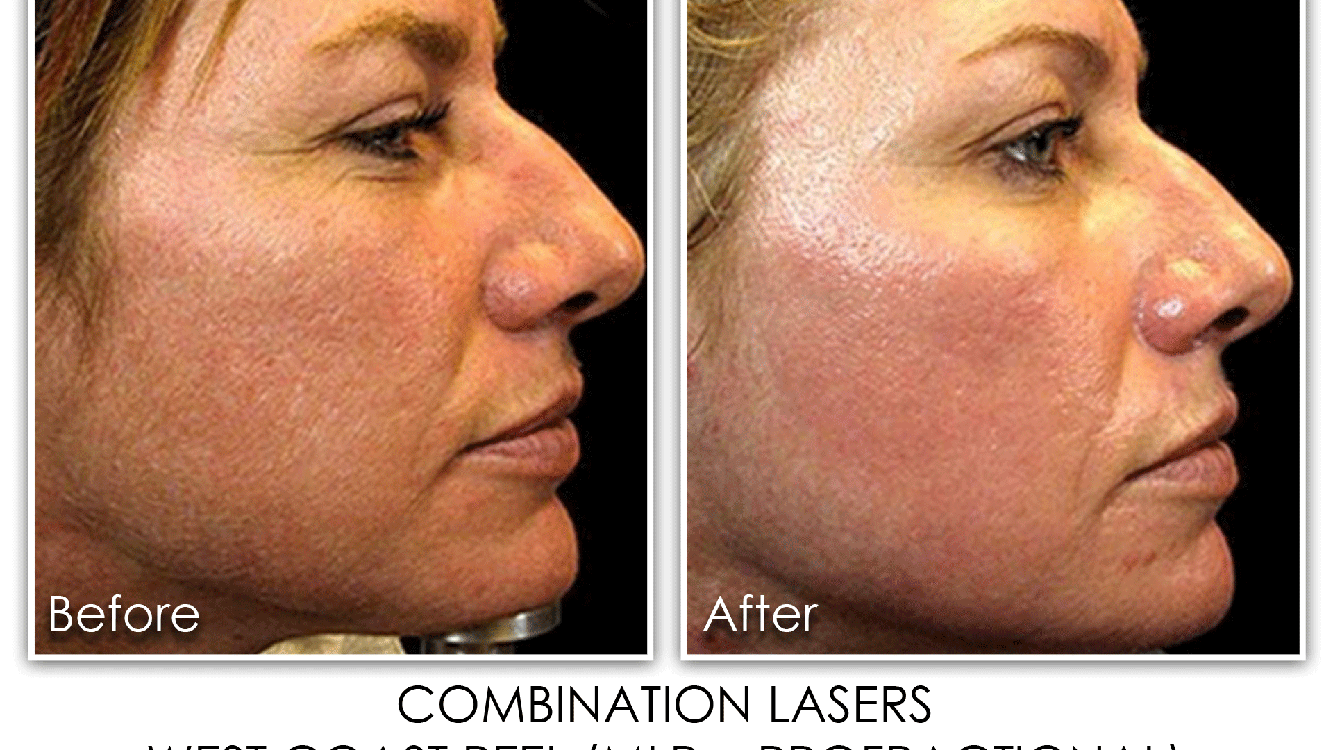 5 Combination Laser Skin Rejuvenation Clinic Skin Rejuvenation Clinic