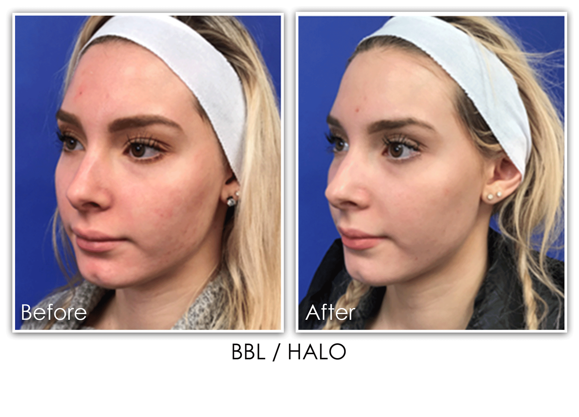 4 BBL - Skin Rejuvenation Clinic Skin Rejuvenation Clinic