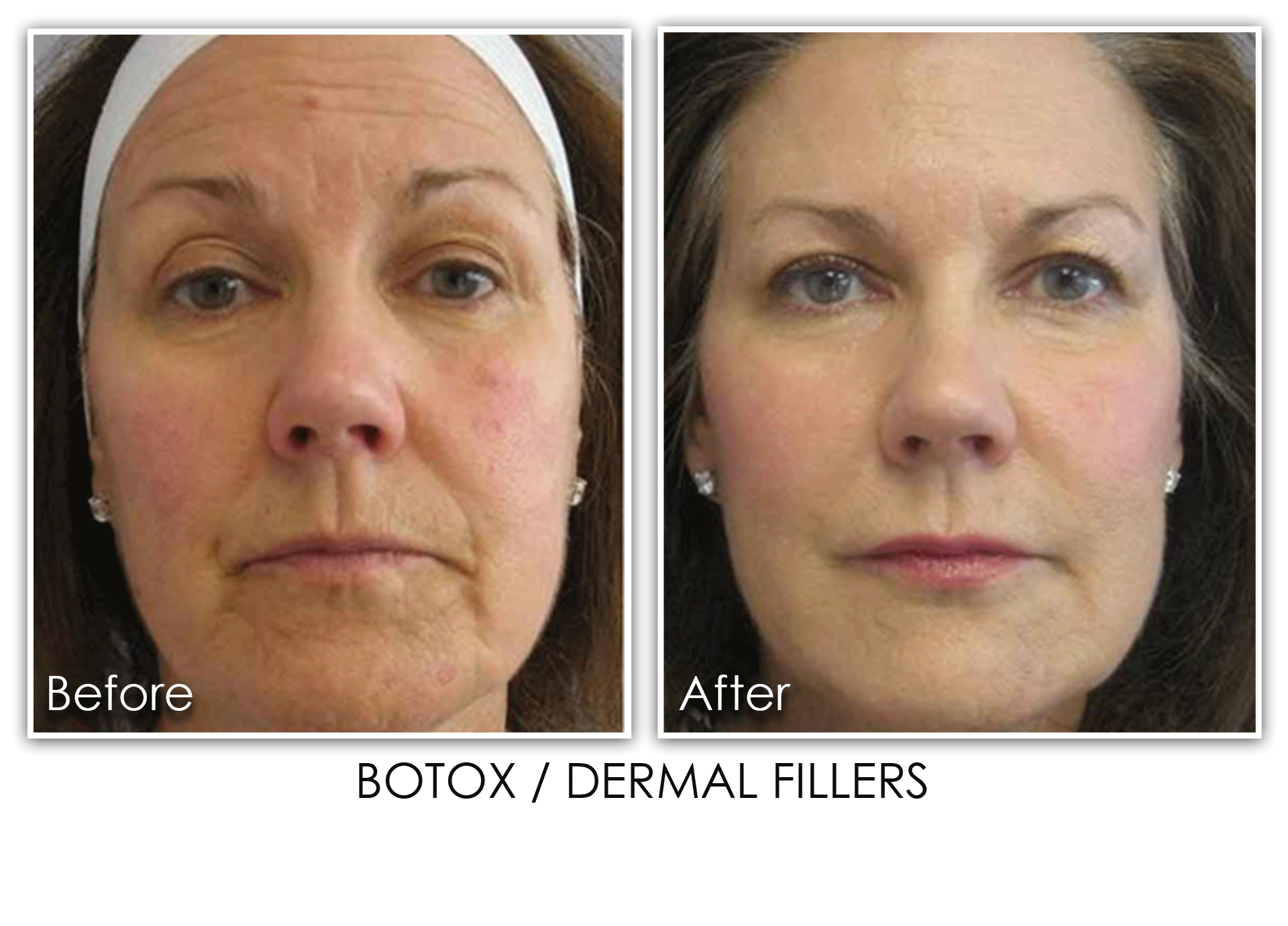 6 Botox - Skin Rejuvenation Clinic Skin Rejuvenation Clinic