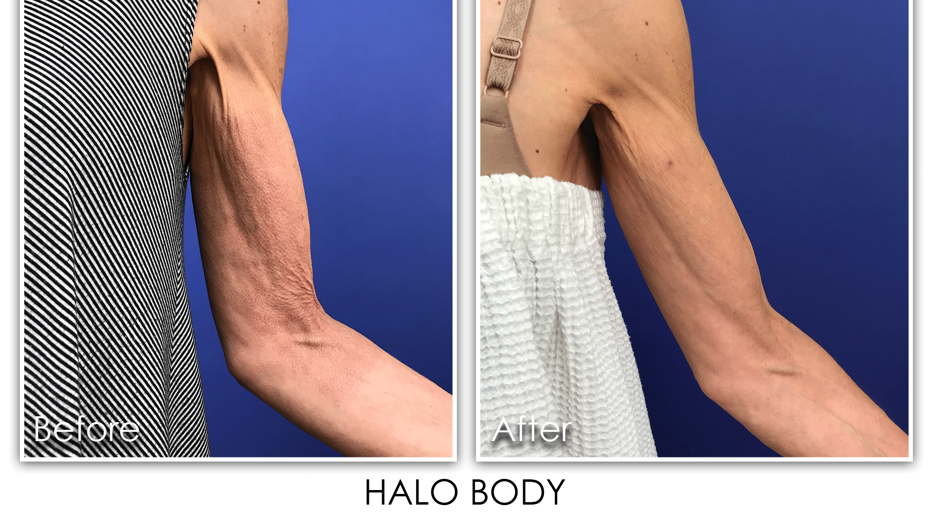 6 HALO BODY - Skin Rejuvenation Clinic Skin Rejuvenation Clinic