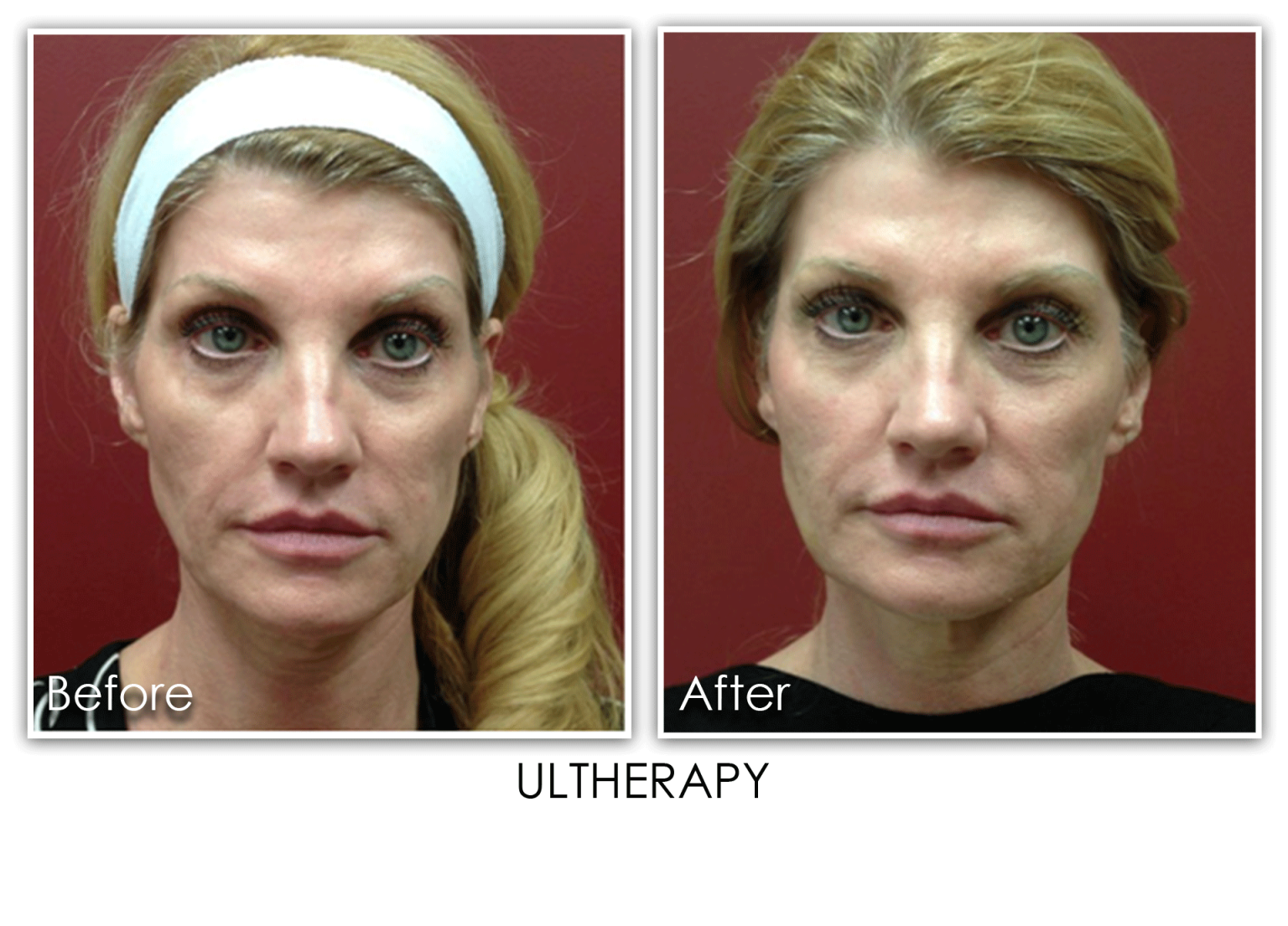 Ultherapy Non Surgical Facelift Skin Rejuvenation Clinic Skin