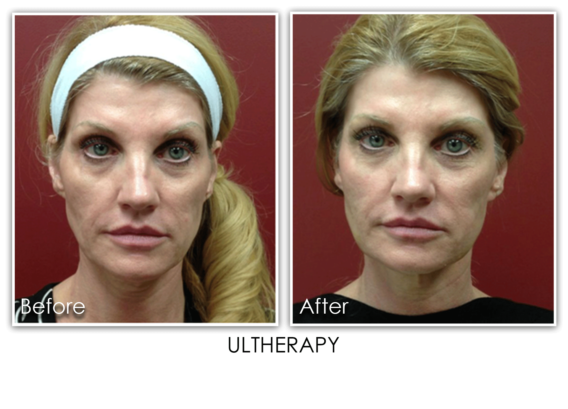 6 Ultherapy - Skin Rejuvenation Clinic Skin Rejuvenation Clinic