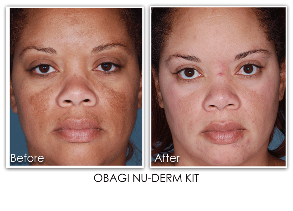Obagi Nu-Derm Archives - Skin Rejuvenation Clinic Skin Rejuvenation Clinic