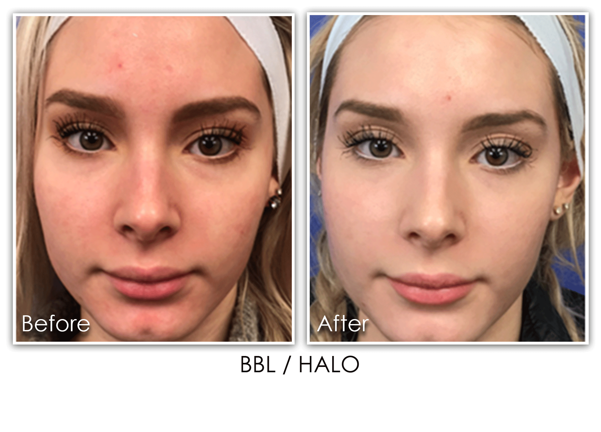 5 BBL - Skin Rejuvenation Clinic Skin Rejuvenation Clinic