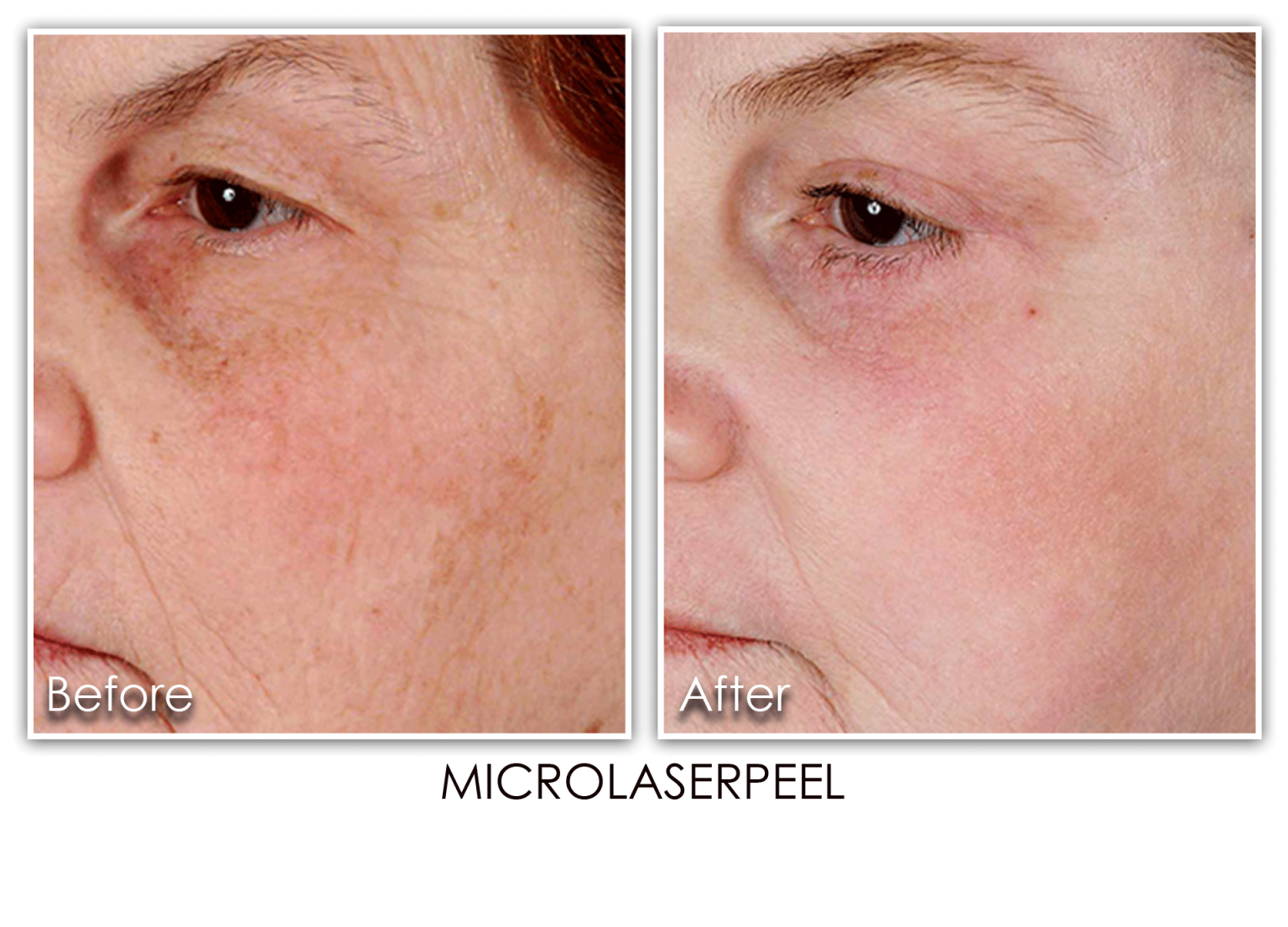 MicroLaserPeel - Skin Rejuvenation Clinic Skin Rejuvenation Clinic