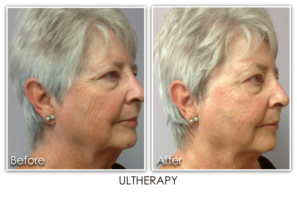 Ultherapy (Non-Surgical Facelift) | Skin Rejuvenation Clinic Skin ...