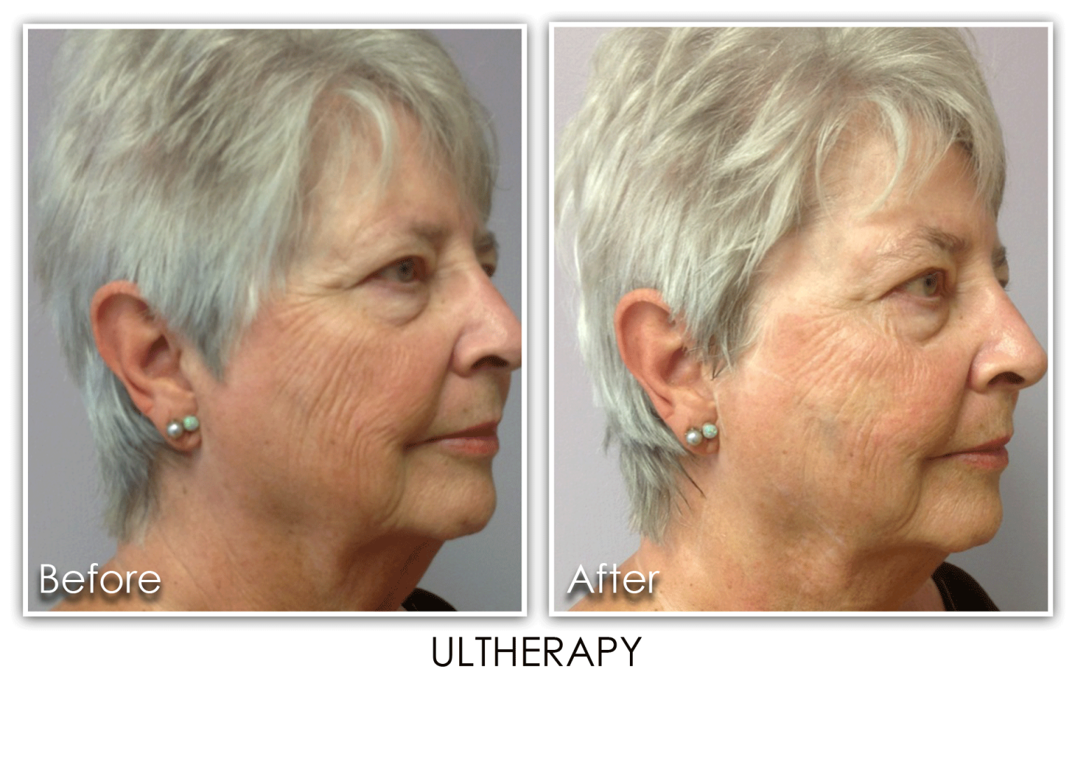 Ultherapy (Non-Surgical Facelift) | Skin Rejuvenation Clinic Skin ...