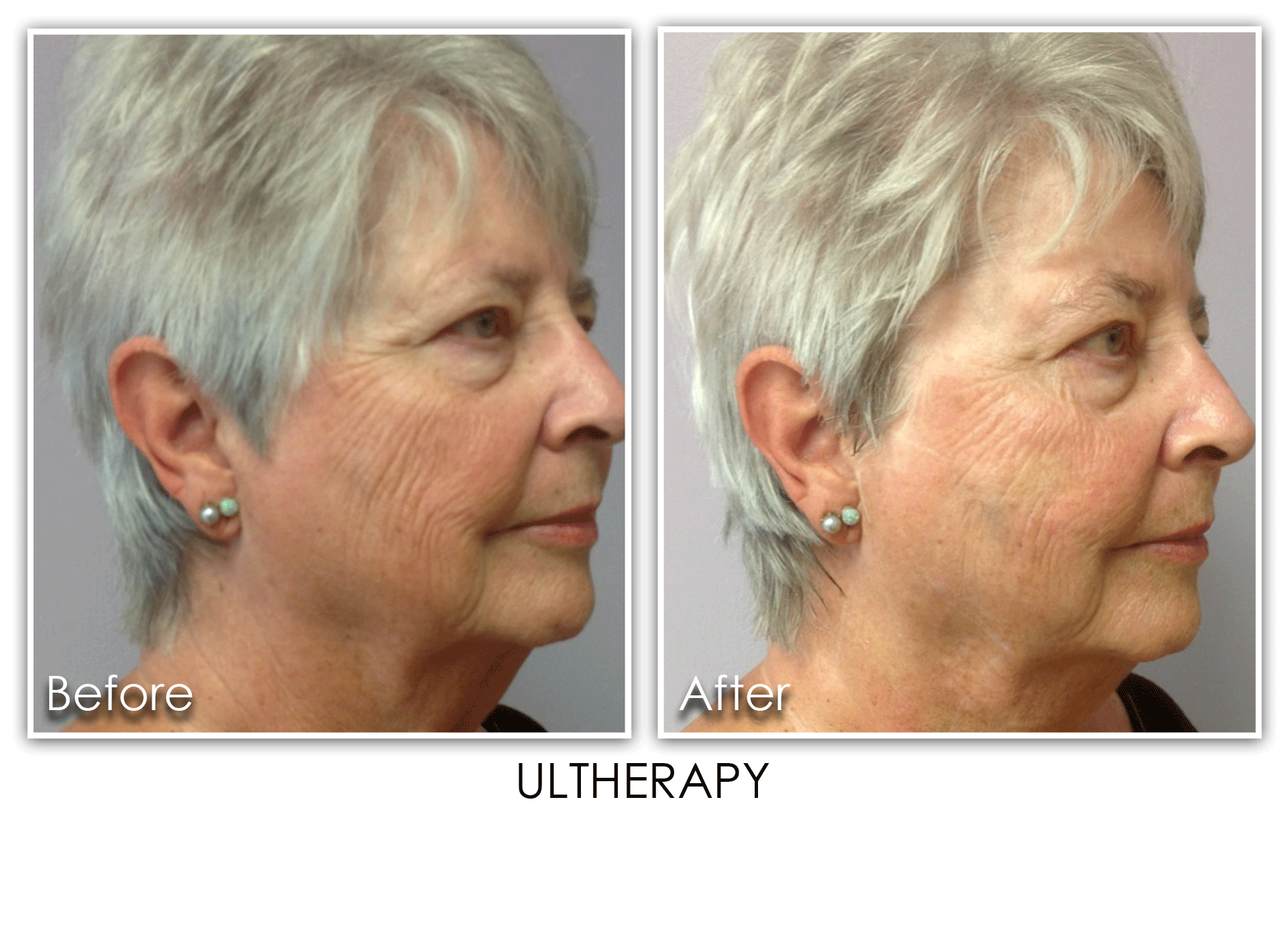 7 Ultherapy - Skin Rejuvenation Clinic Skin Rejuvenation Clinic