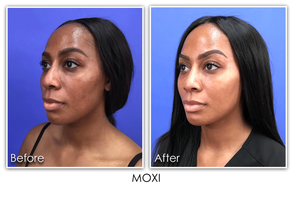 Moxi (Mini Halo) Laser | Skin Rejuvenation Clinic Skin Rejuvenation Clinic