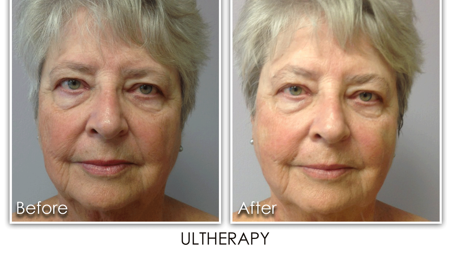 8 Ultherapy - Skin Rejuvenation Clinic Skin Rejuvenation Clinic