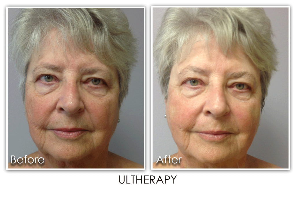 Ultherapy Archives - Skin Rejuvenation Clinic Skin Rejuvenation Clinic