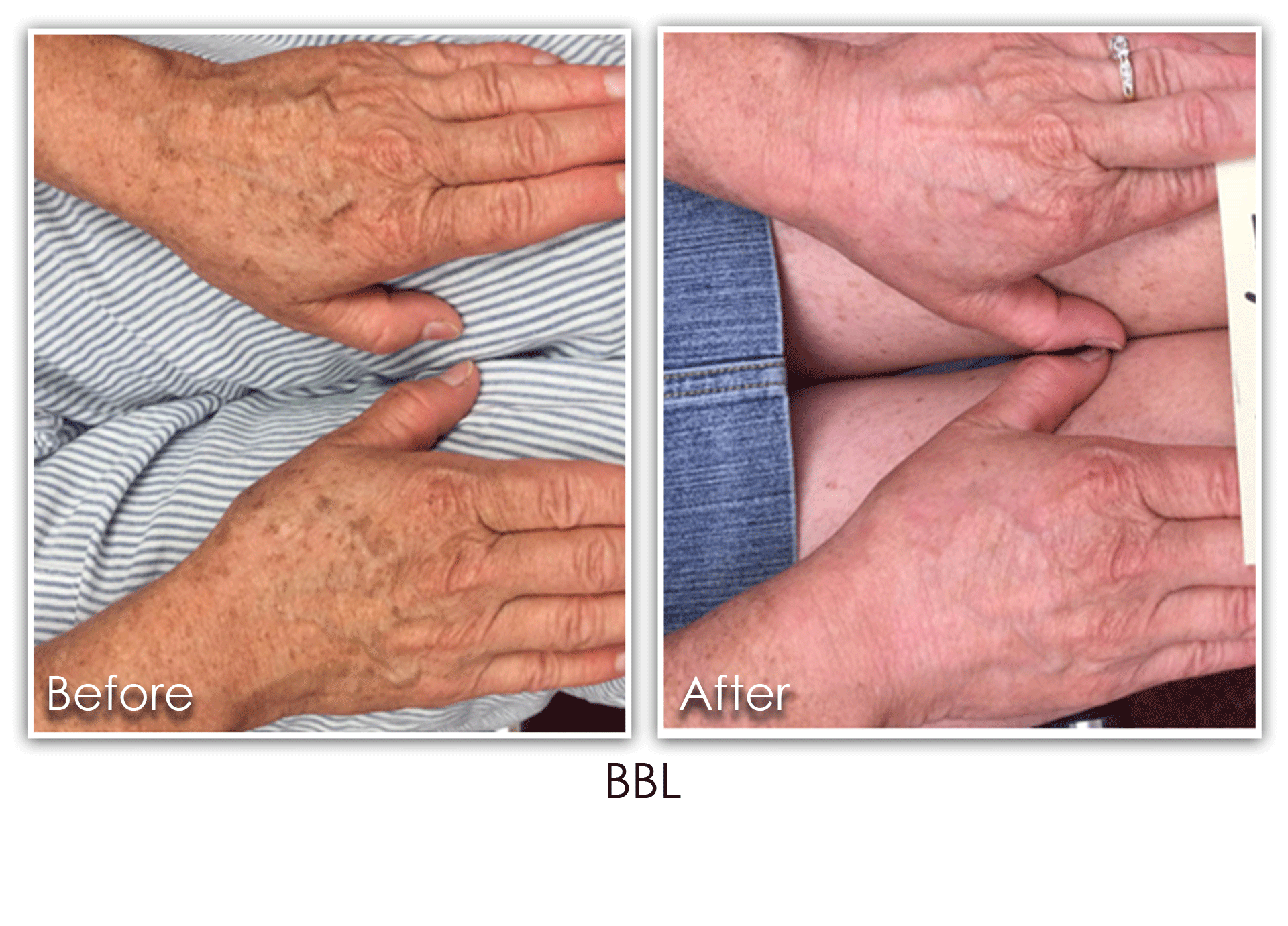 7 BBL - Skin Rejuvenation Clinic Skin Rejuvenation Clinic