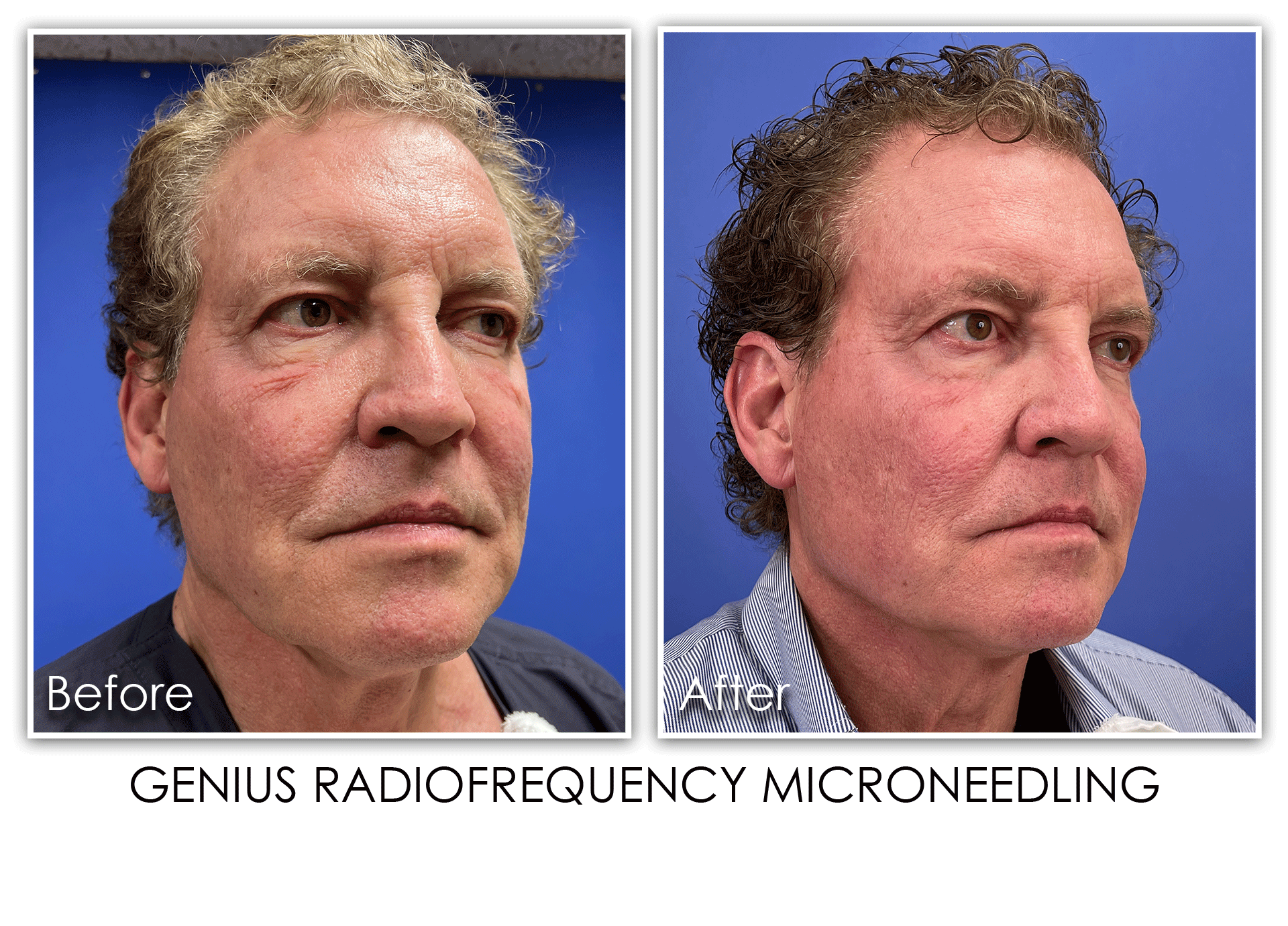 1 Genius Radio Frequency Skin Rejuvenation Clinic Skin Rejuvenation
