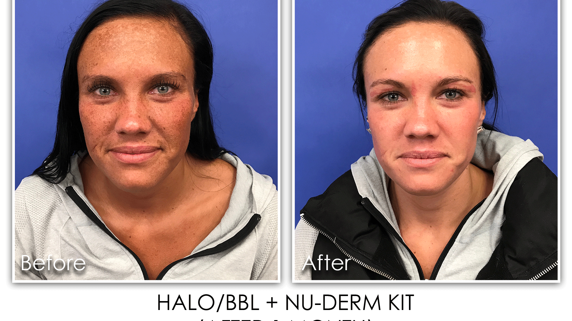 10 BBL - Skin Rejuvenation Clinic Skin Rejuvenation Clinic