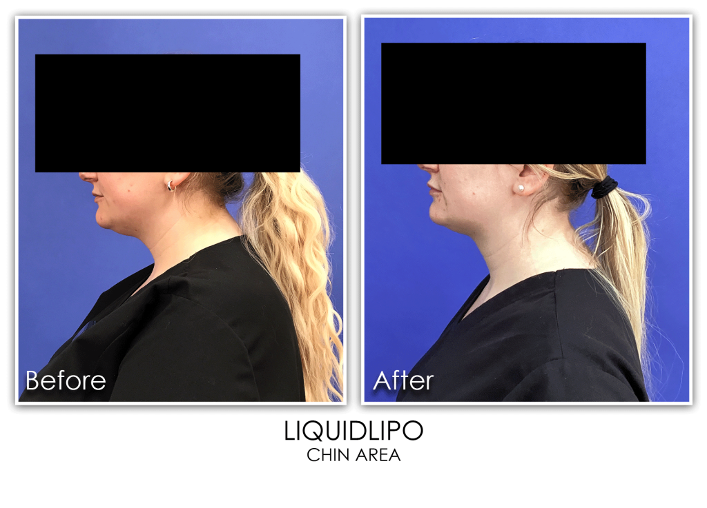 LiquidLipo Archives - Skin Rejuvenation Clinic Skin Rejuvenation Clinic