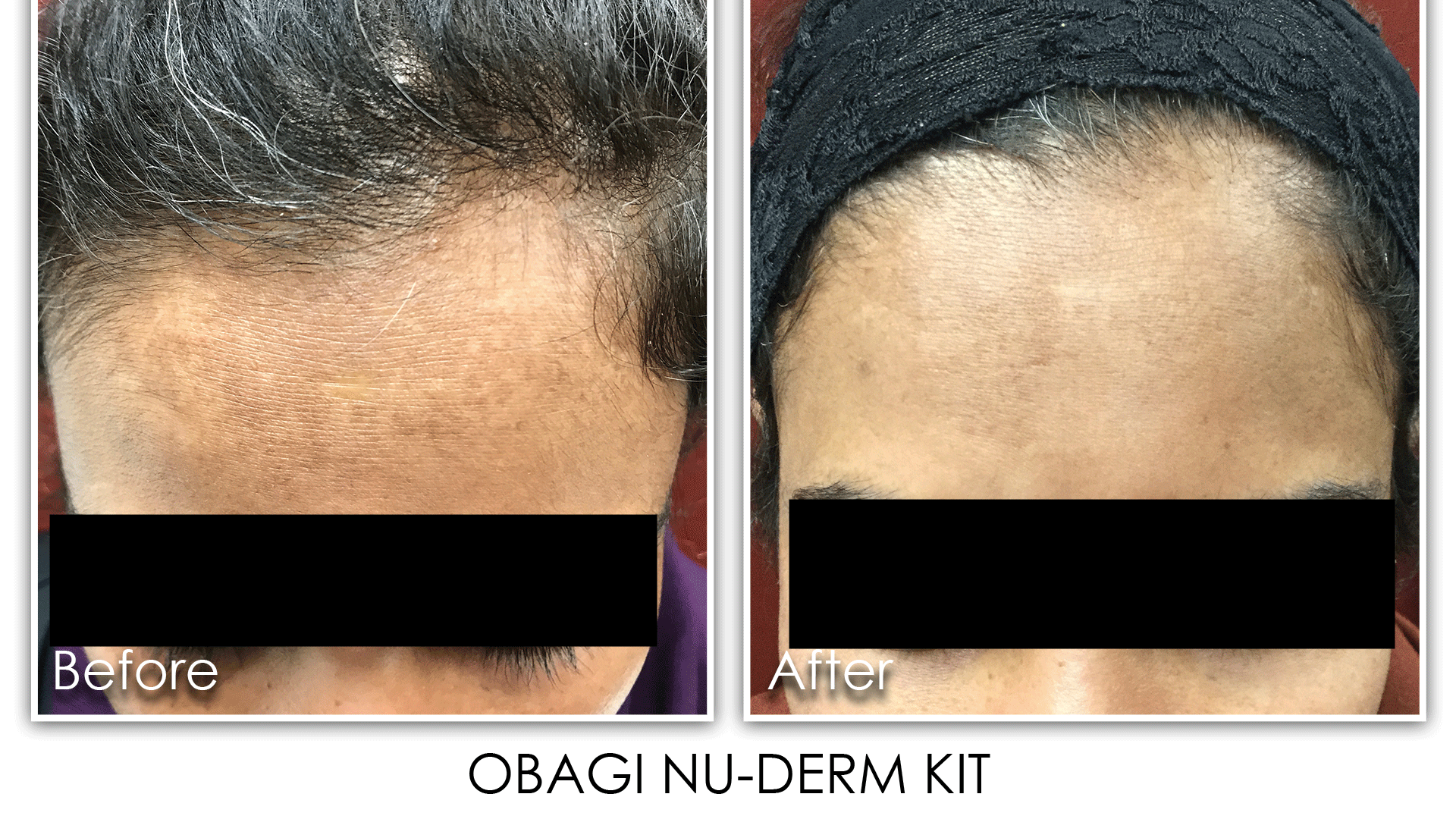 8 Obagi Nu Derm Kit - Skin Rejuvenation Clinic Skin Rejuvenation Clinic