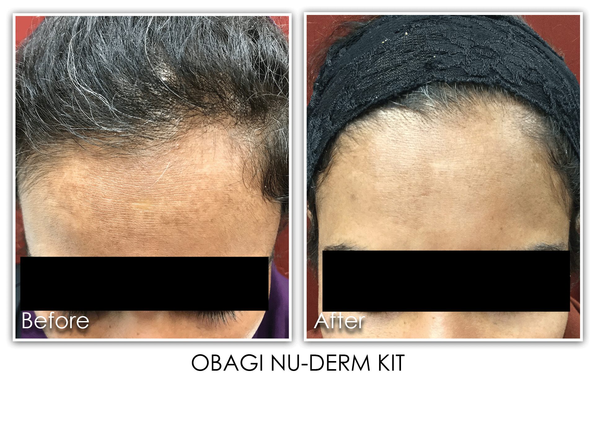 8 Obagi Nu Derm Kit - Skin Rejuvenation Clinic Skin Rejuvenation Clinic