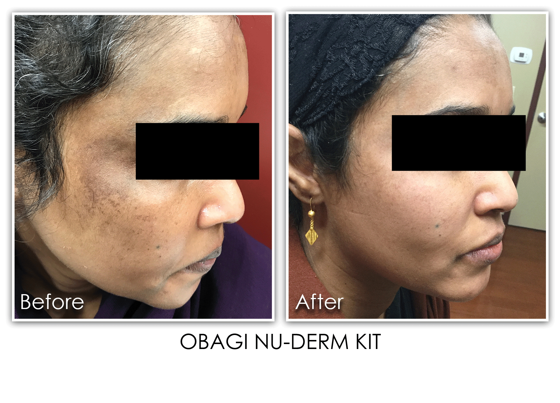 9 Obagi Nu Derm Kit - Skin Rejuvenation Clinic Skin Rejuvenation Clinic