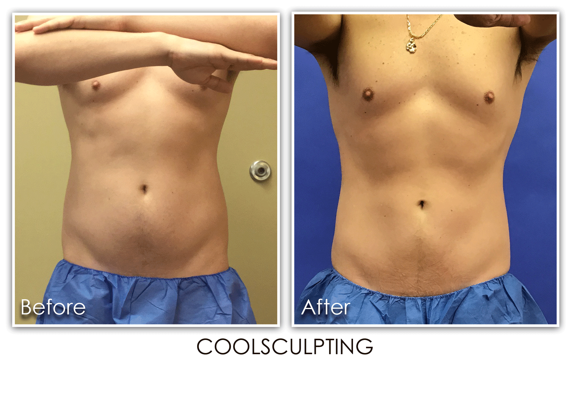2 CoolSculpting - Skin Rejuvenation Clinic Skin Rejuvenation Clinic