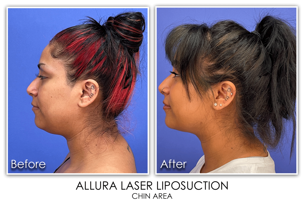 Allura Prolipo Laser Liposuction Archives - Skin Rejuvenation Clinic ...