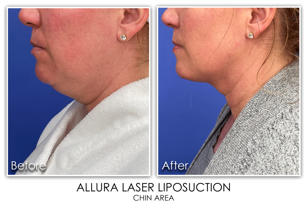 Galleries Archive - Skin Rejuvenation Clinic Skin Rejuvenation Clinic