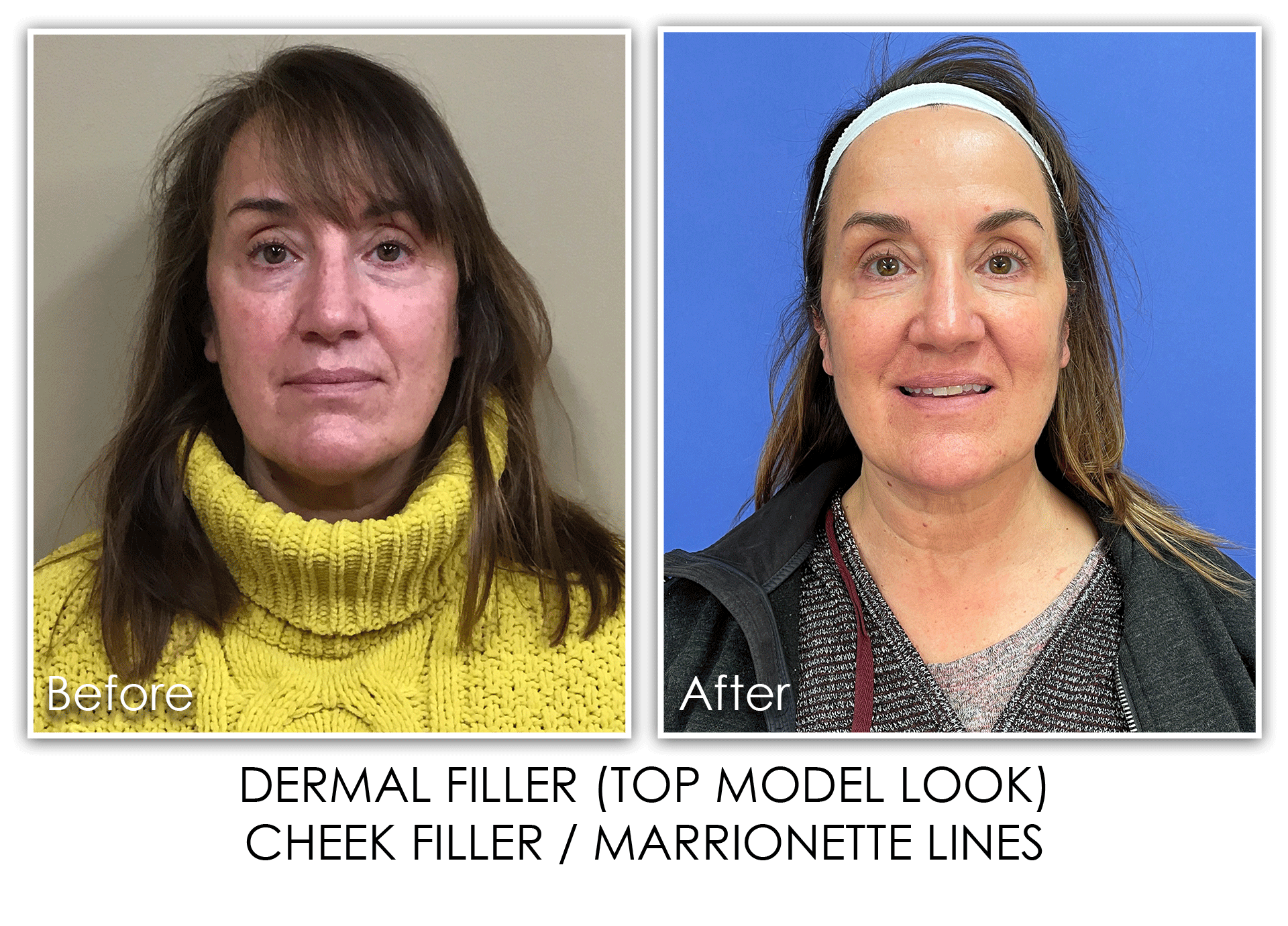 36 DERMAL FILLER CHEEK UNDER EYE FILLER - Skin Rejuvenation Clinic Skin ...